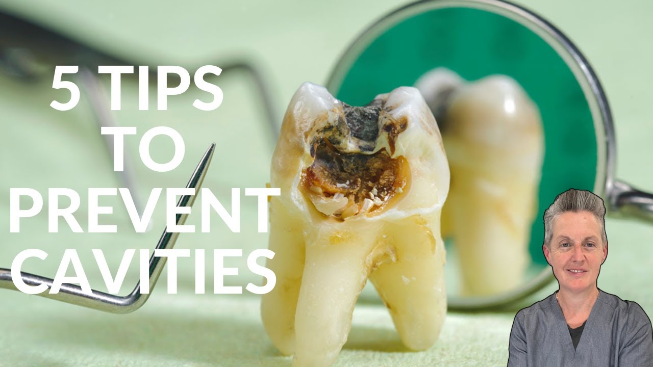 Healthy Smile Hack: 5 Dental Cavity Prevention Tips - YouTube