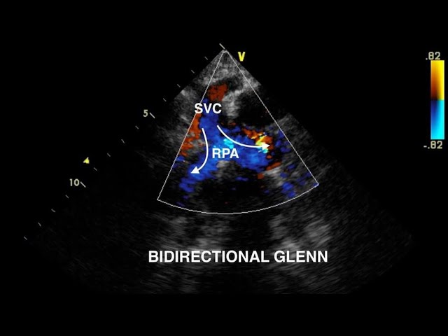 Bidirectional Glenn