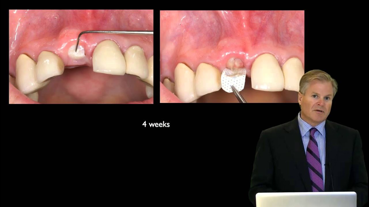 249-00 Alveolar Ridge Preservation for Implant and Pontic Site ...