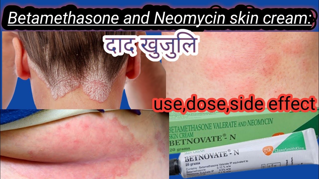 Betamethasone and Neomycin skin cream use in nepali//betnovate n cream ...