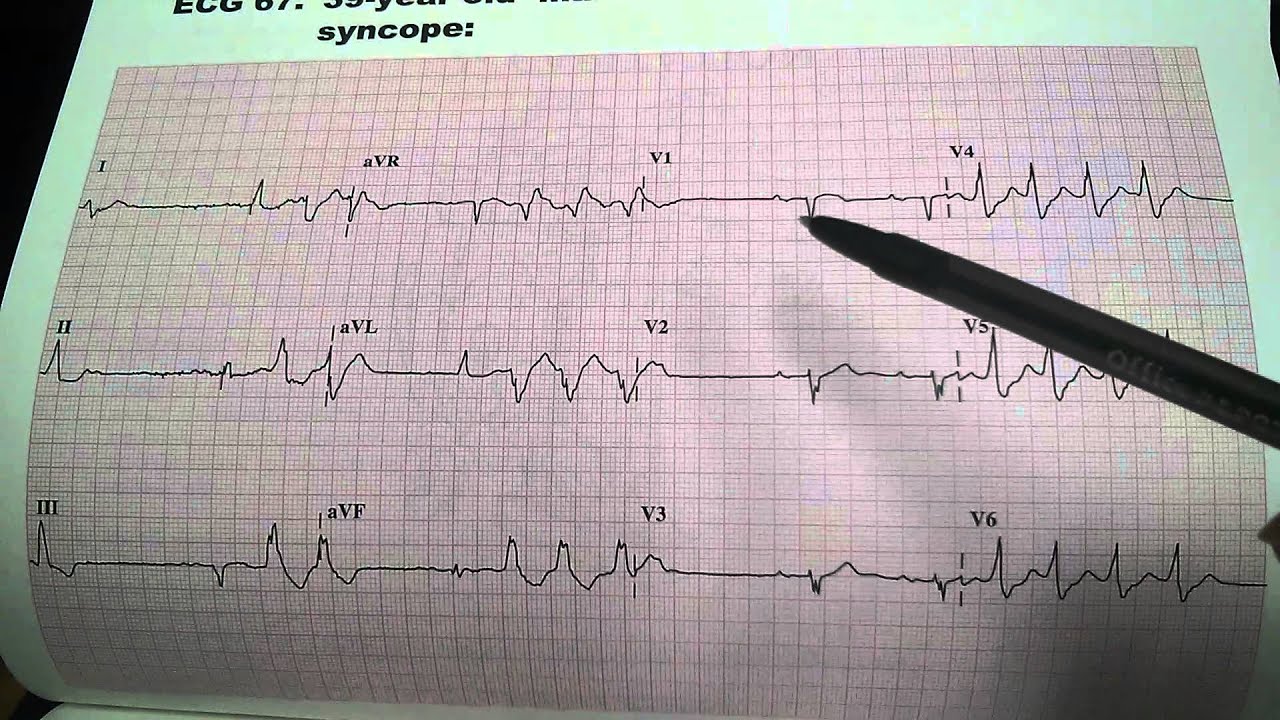 Cardiomegaly Syncope ECG EKG electrocardiogram Uri Ben-Zur MD - YouTube