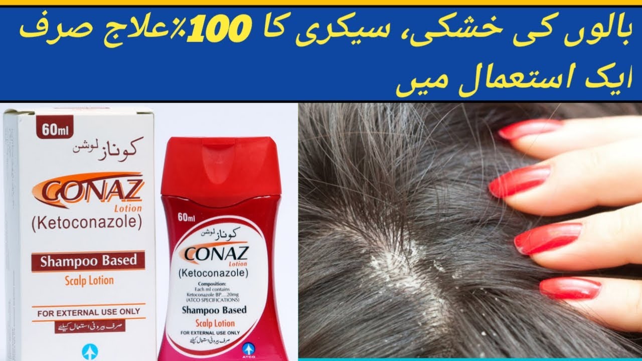 How to use Conaz Shampoo| How to Get rid of dandruff| DIY - YouTube