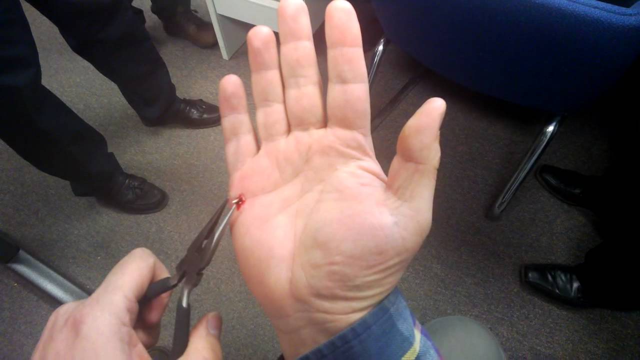 This is how you don't pull an impaled fishing hook out of your own hand ...