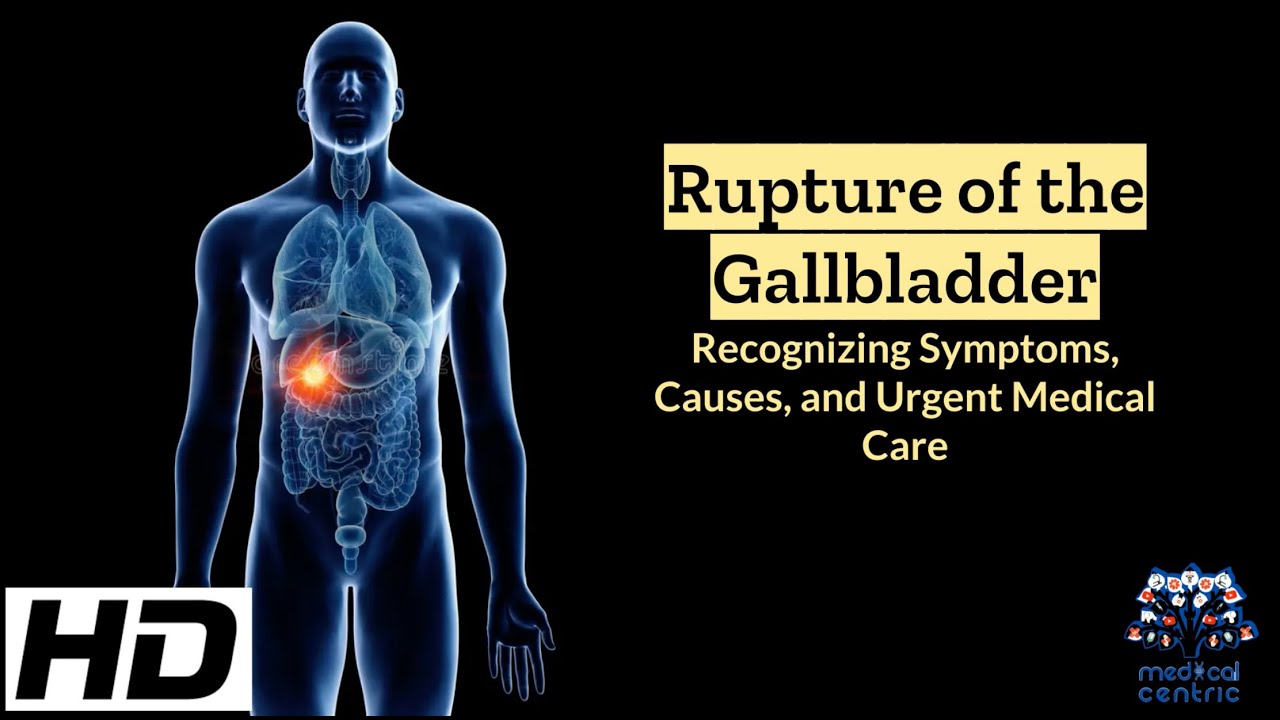Ruptured Gallbladder Emergency Signs Causes And Lifesaving Tips