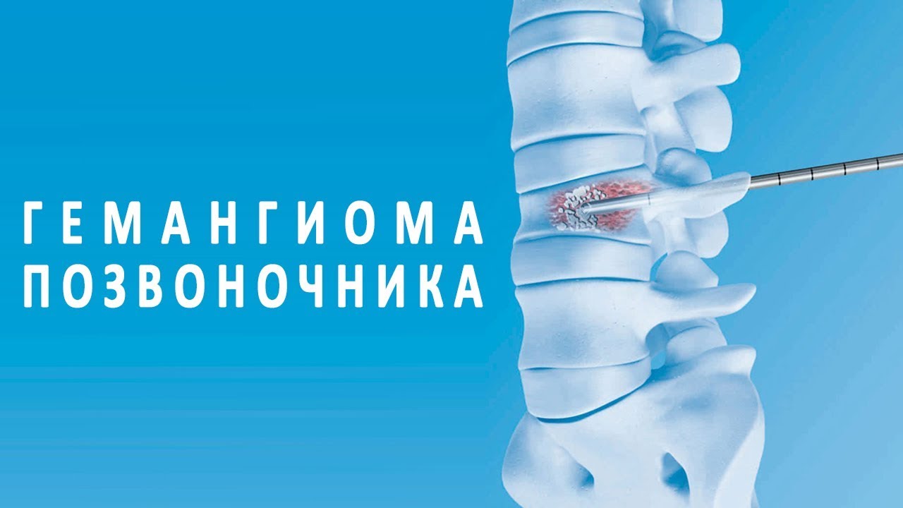 Что такое гемангиома позвоночника и как она лечится Youtube