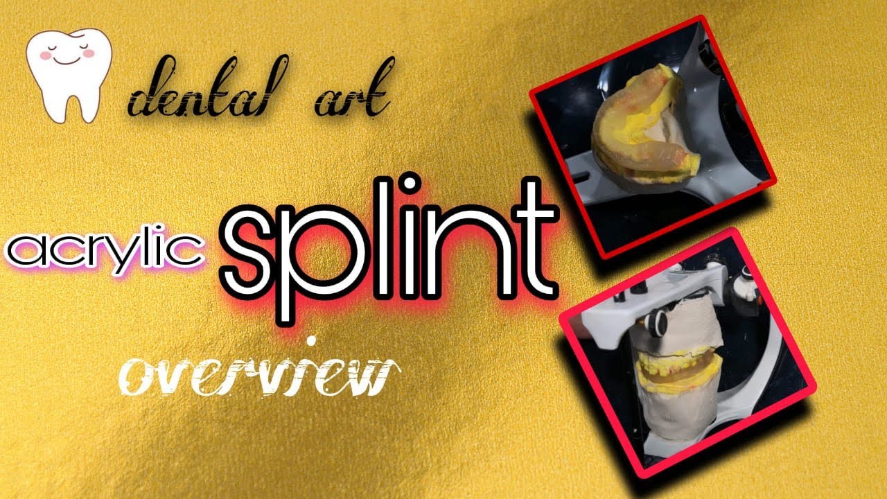 Acrylic splint for bruxism : Part 1 : developing the occlusal surface ...