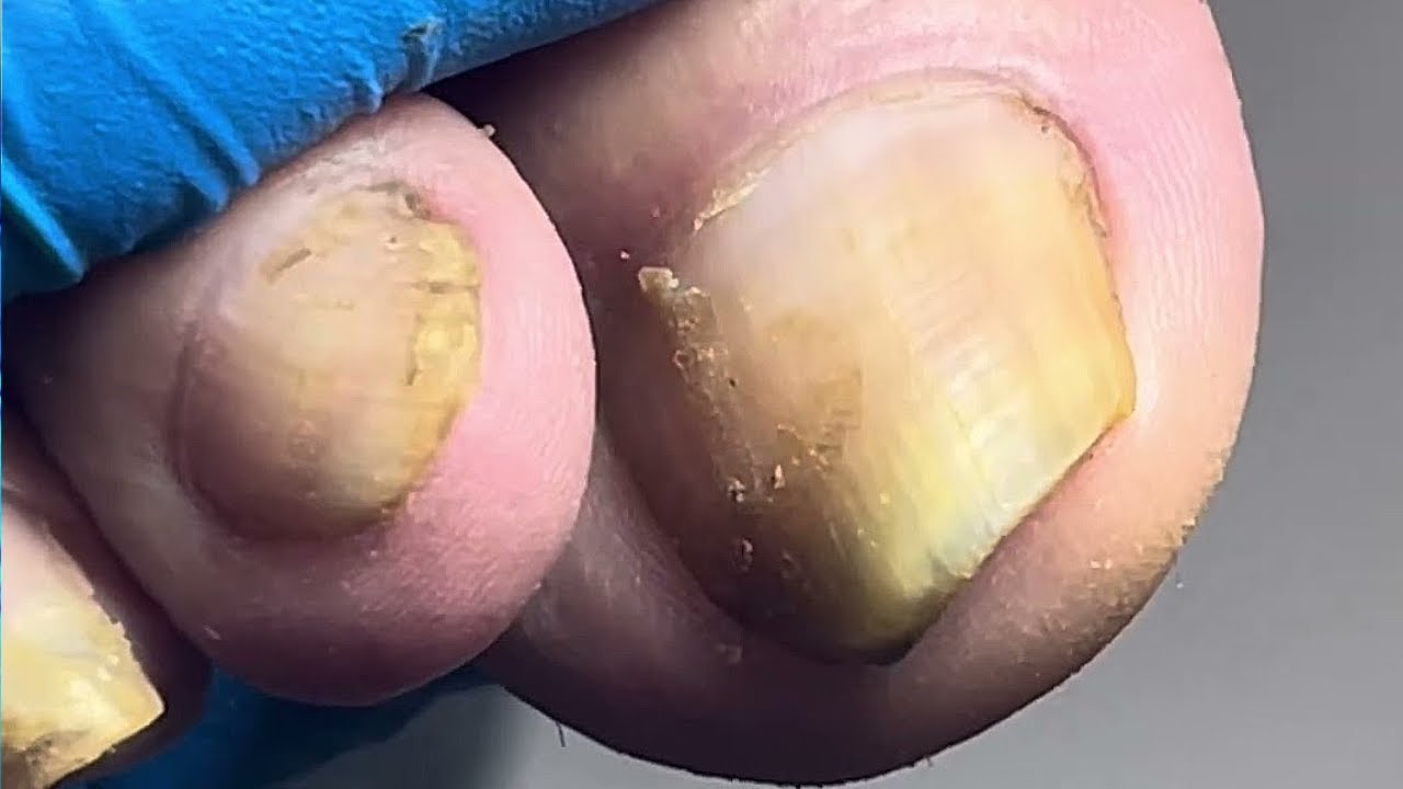 Easily Trim Toenails That Are Too Long #pedicure - YouTube