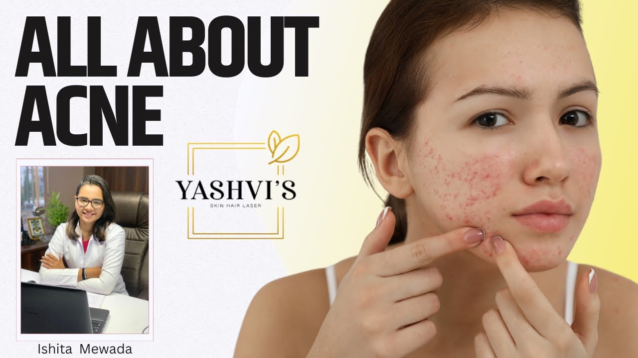 “all About Acne What Is Acne Types Of Acne Causes Of Acne Youtube