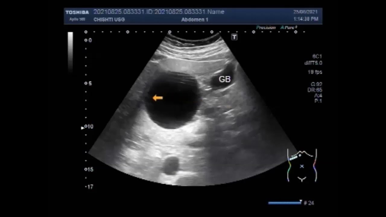 Hepatic Hydatid Cyst. Two cases. - YouTube