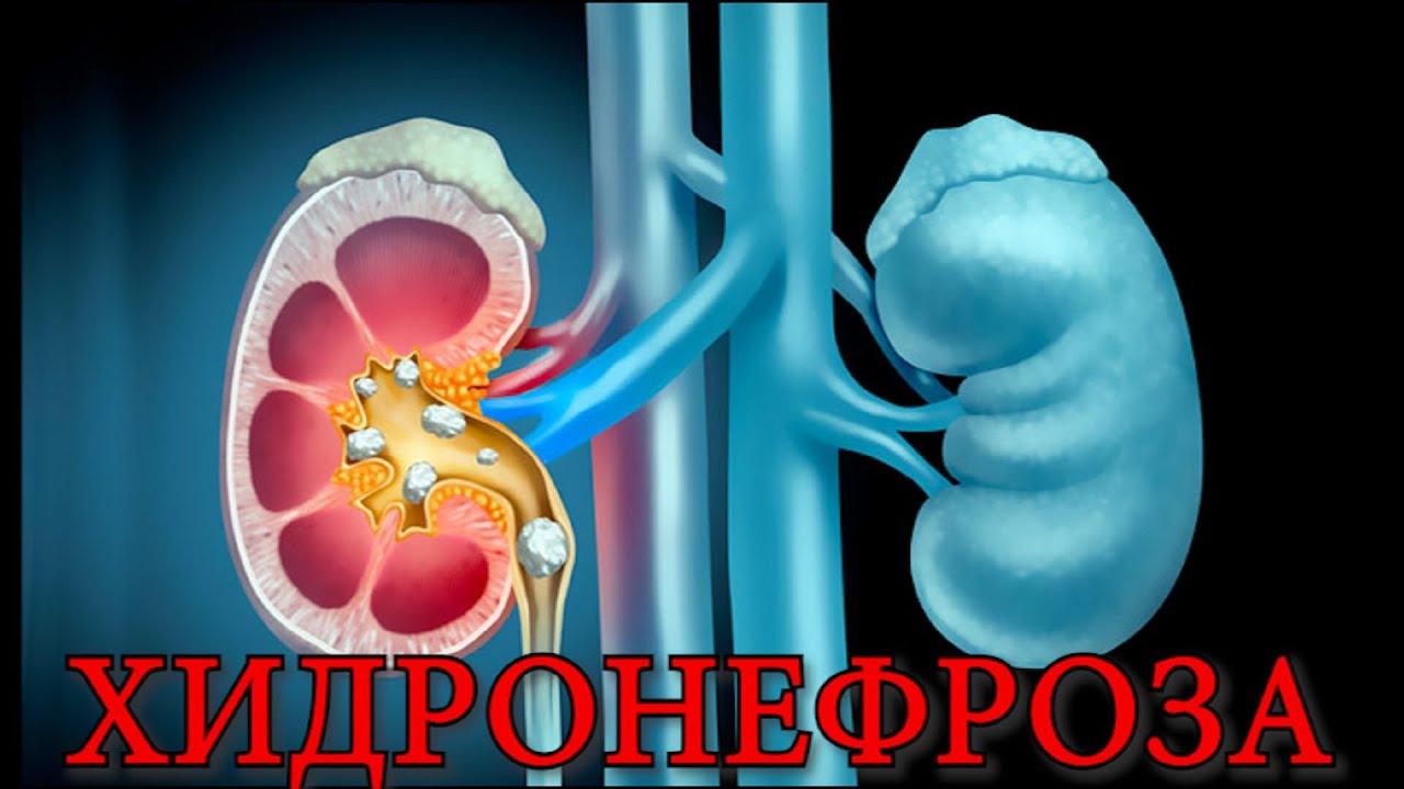 Бъбречна криза симптоми и лечение Youtube