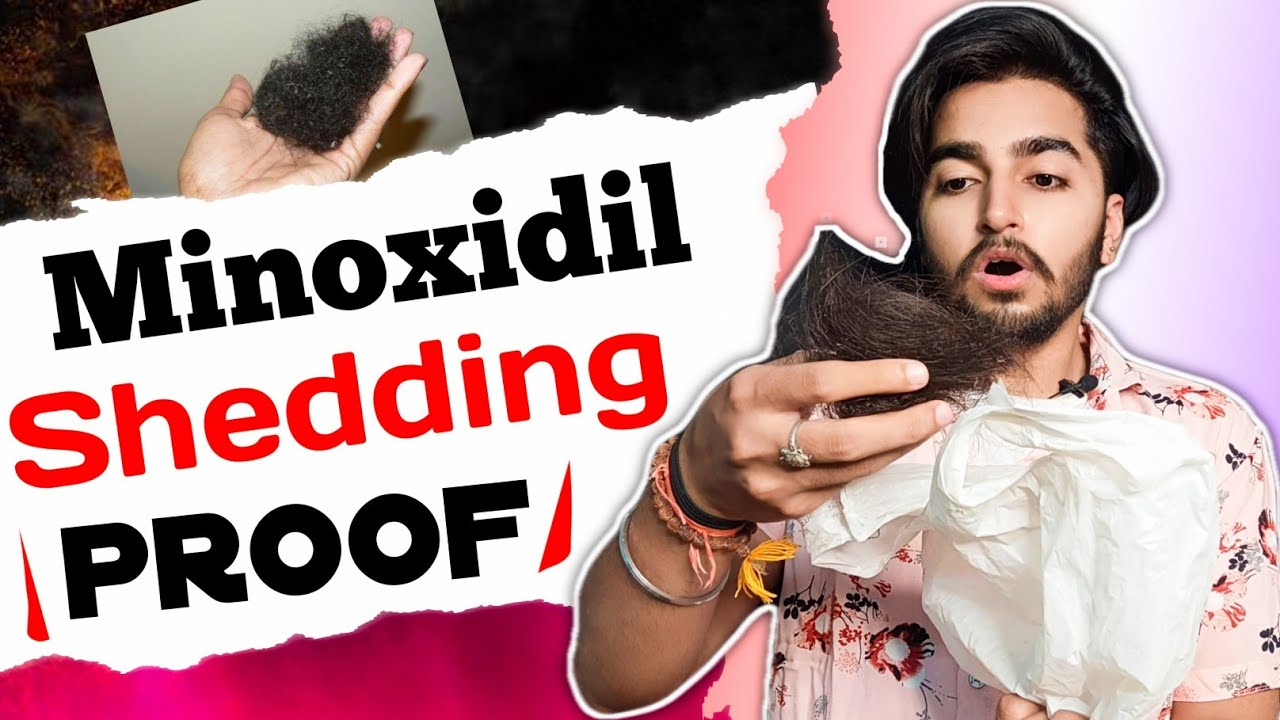 My Minoxidil Shedding Proof | Shedding Hair Collect | Sahil Nagpal ...