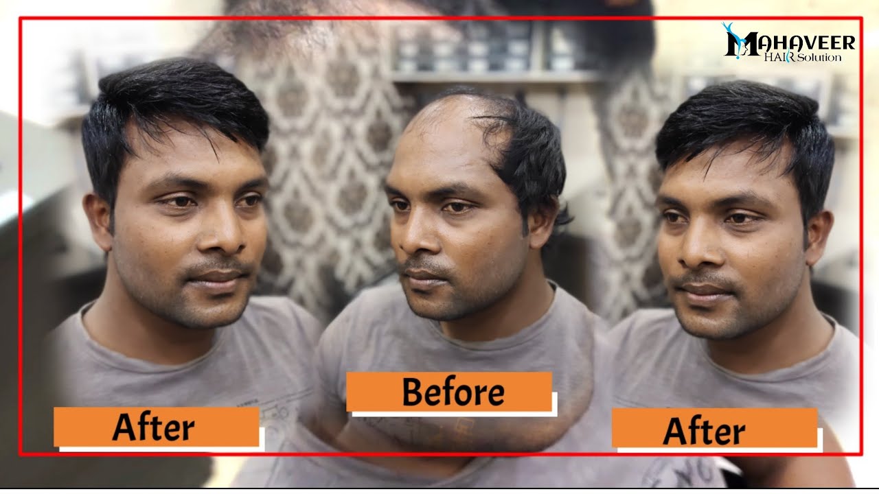 Hair Patch For Men | Natural Hair Patch In India | HAIR PATCH ...