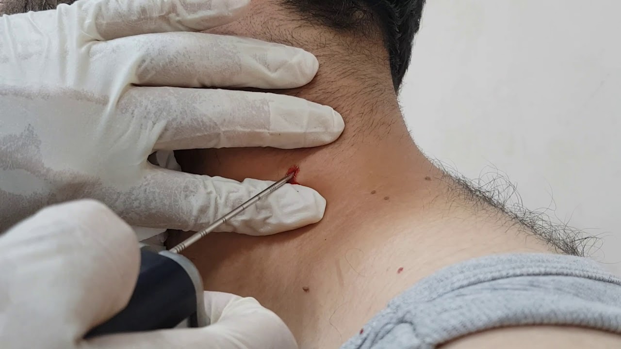 Hodgkins Lymphoma Neck Youtube