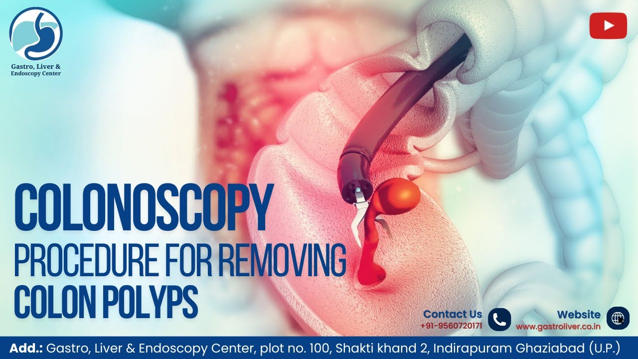 Colonoscopy Procedure for Removing Colon Polyps | Dr. Manish Gupta ...