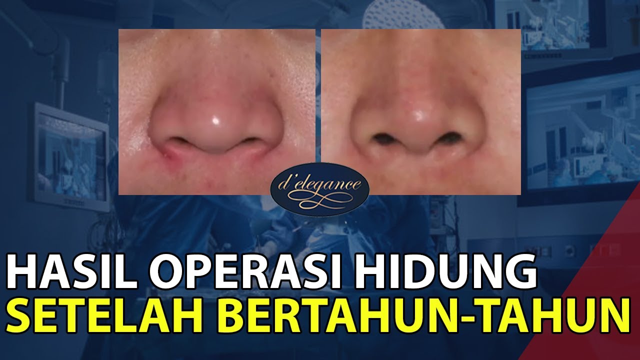Operasi plastik hidung setelah 2 tahun. - YouTube
