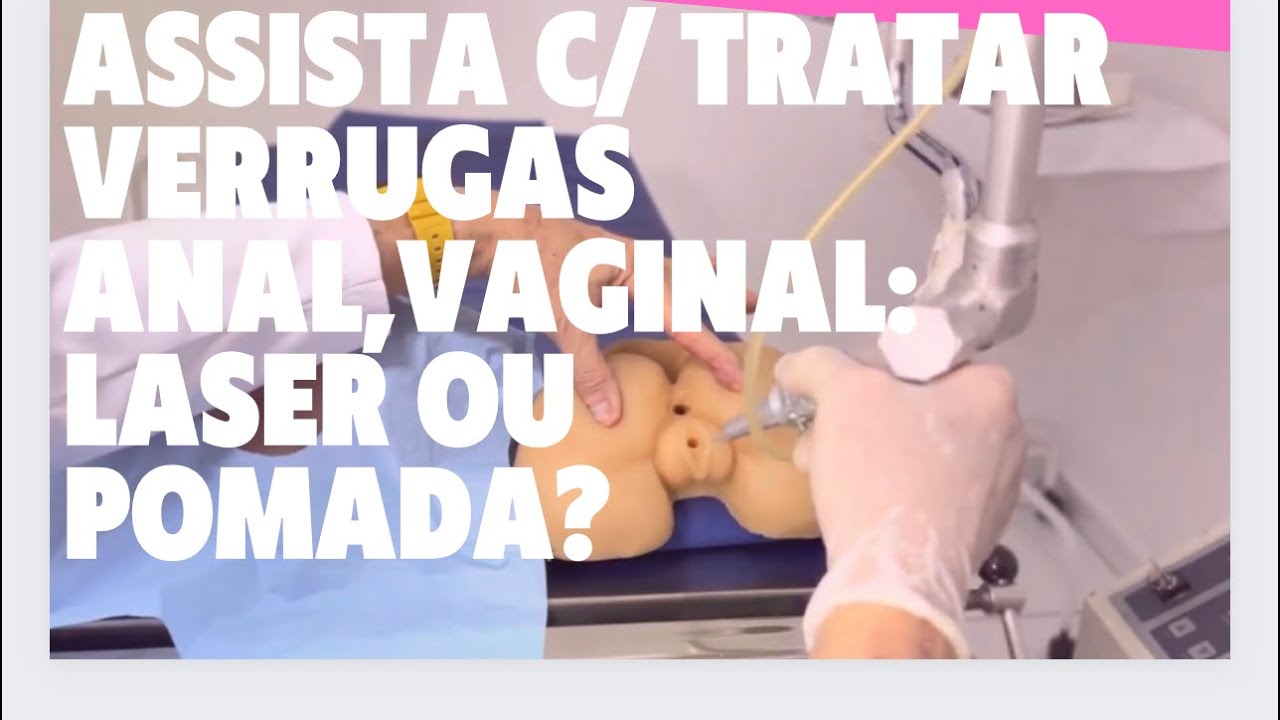 Verrugas anus e vagina: Pomada ou laser? - YouTube