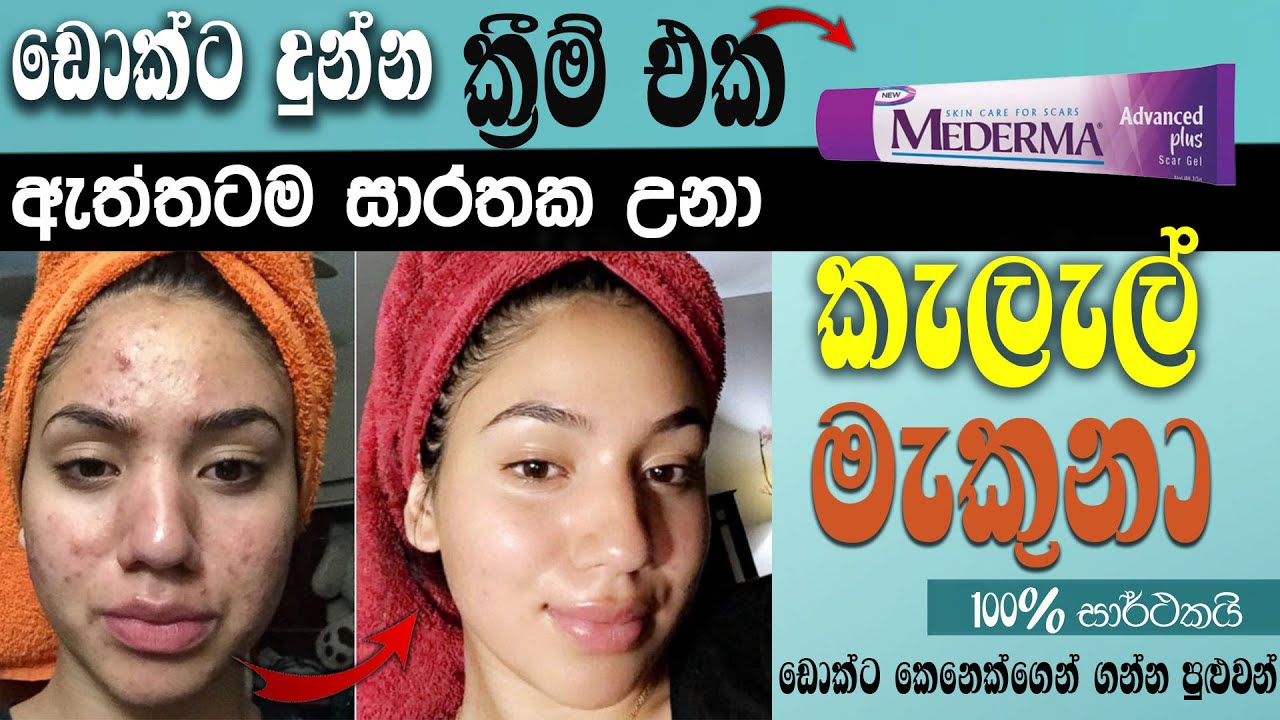 කුරුලෑ වලවල් දින 3 න් නැති කරන බෙහෙත් | lapa kalal walata beheth | lapa ...