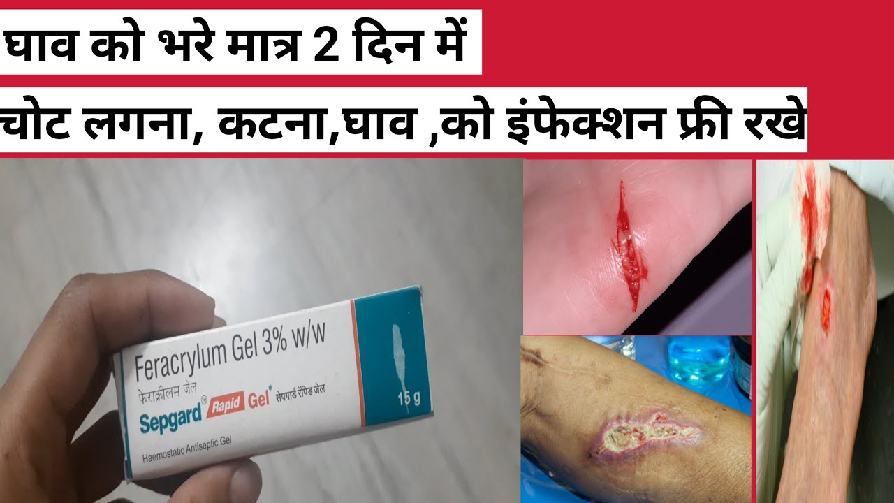 Sepgard Rapid Gel Feracrylum 3 w w Wound Infection Treatment sepgard-rapid-gel-feracrylum-3-w-w-wound-infection-treatment