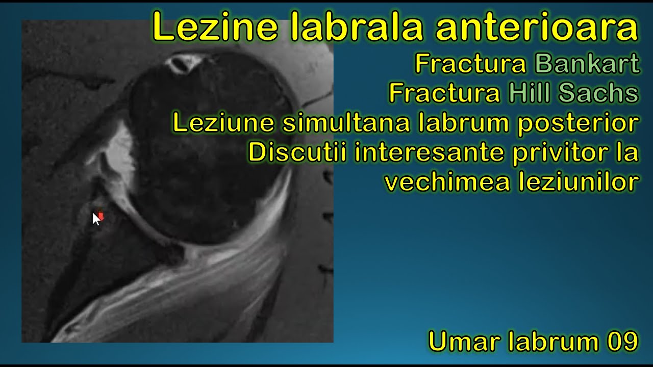 Caz umăr labrum 09 explicat - YouTube