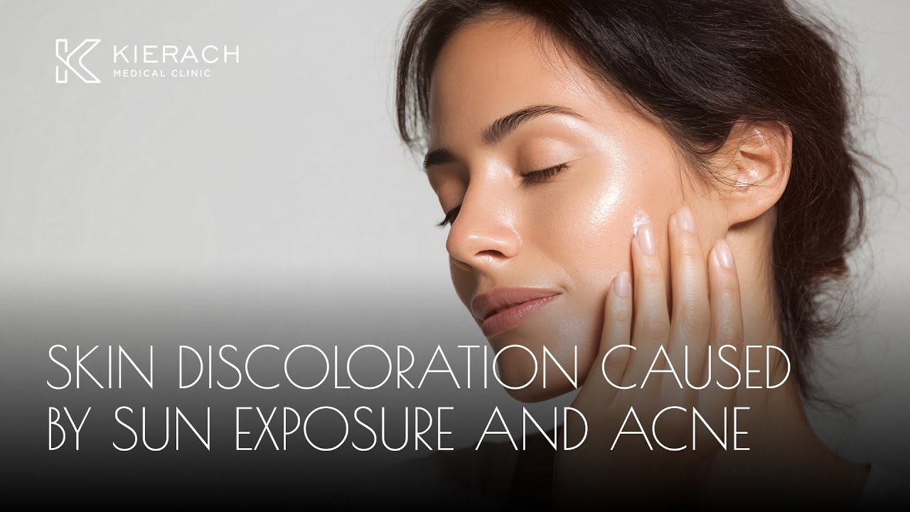 Skin Discoloration After Sun Exposure and Acne - YouTube