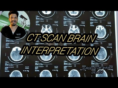 CT Scan Brain Plain Showing SDH EDH SAH Brain Contusion Subgaleal ...
