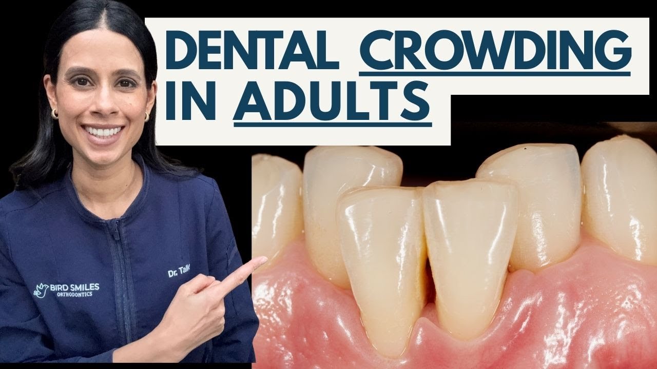 Dentist Explains How To Fix Crowded Teeth! What Is Dental Crowding in ...
