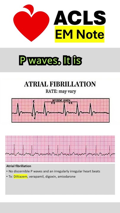 Atrial Fibrillation #acls - YouTube