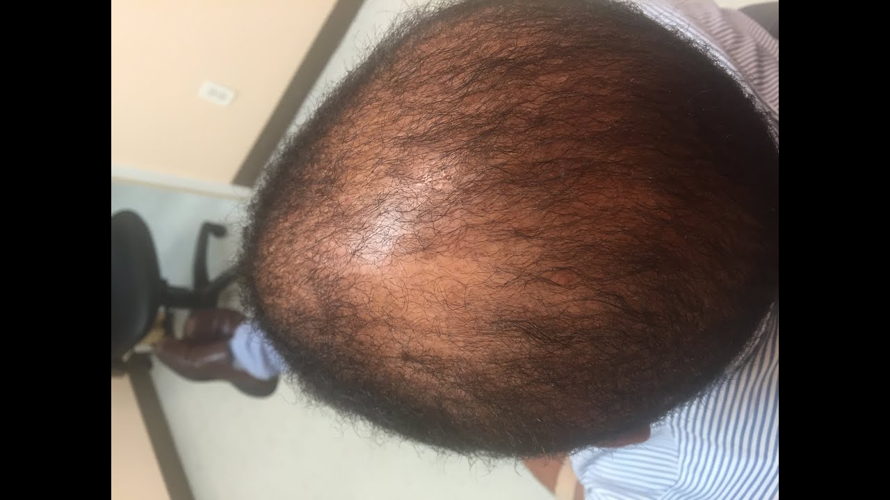 Acell + PRP Hair Regrowth in New York - YouTube