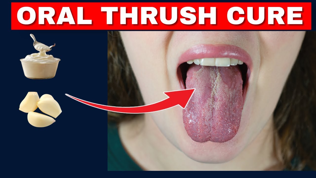 7 Home Remedies to get rid of ORAL THRUSH and White Tongue Quickly ...