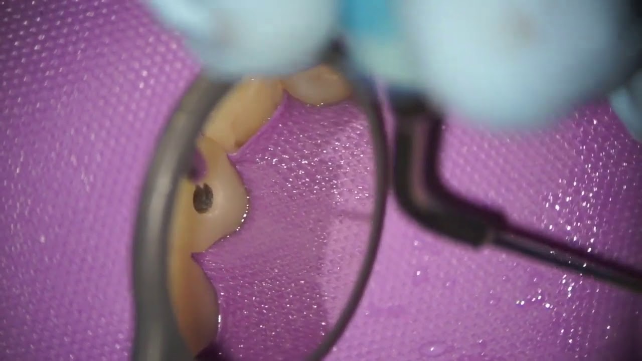 Root Canal Anterior tooth Retreatment with fiber post - YouTube