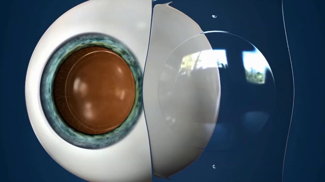 Visian ICL procedure - YouTube