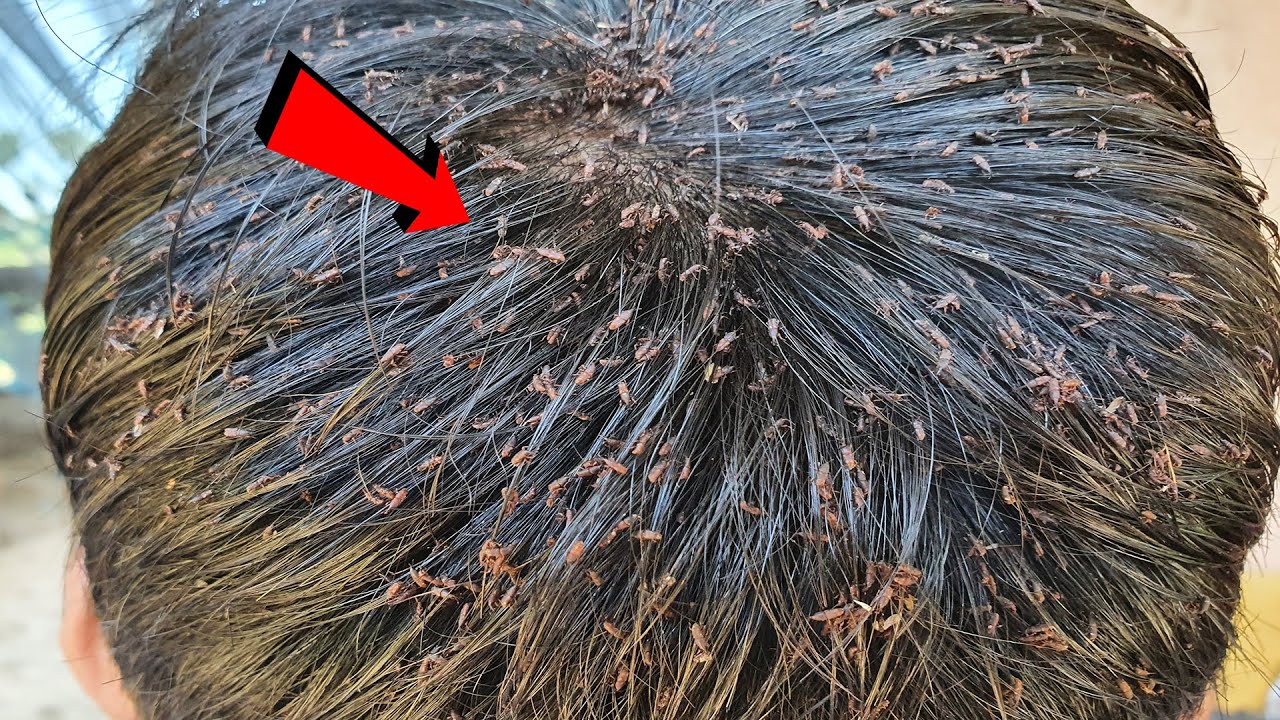 Head lice combing - Big lice removal at home - YouTube