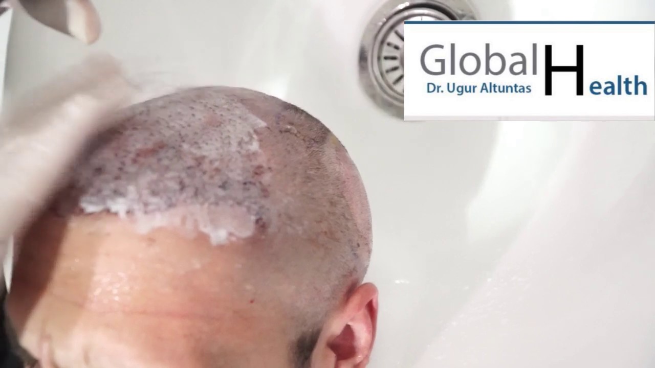 Global Health Istanbul Hair Transplant Turkey Youtube