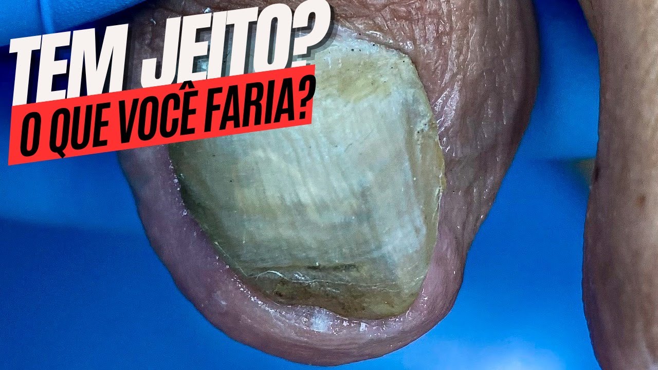 UNHA ONICOGRIFOSE TEM JEITO? | Podóloga Renata Cavalcanti - YouTube