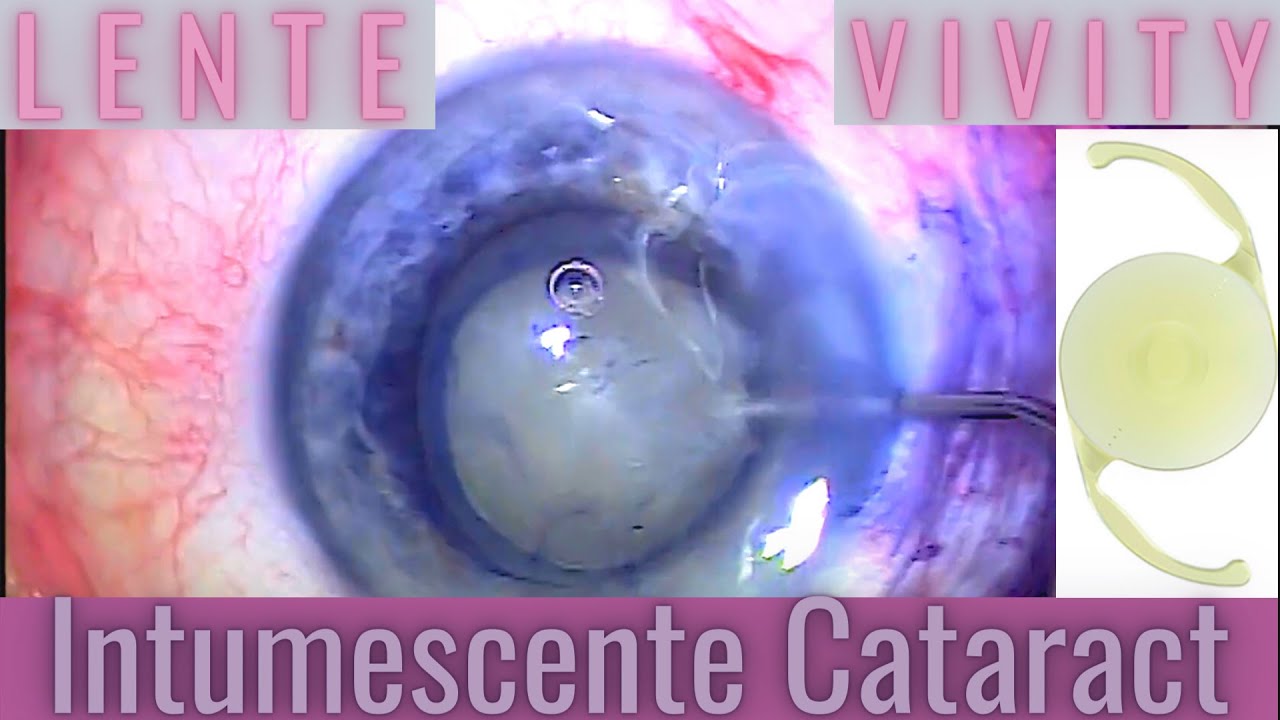 Como solucionamos una Catarata Intumescente con Facodonesis. - YouTube