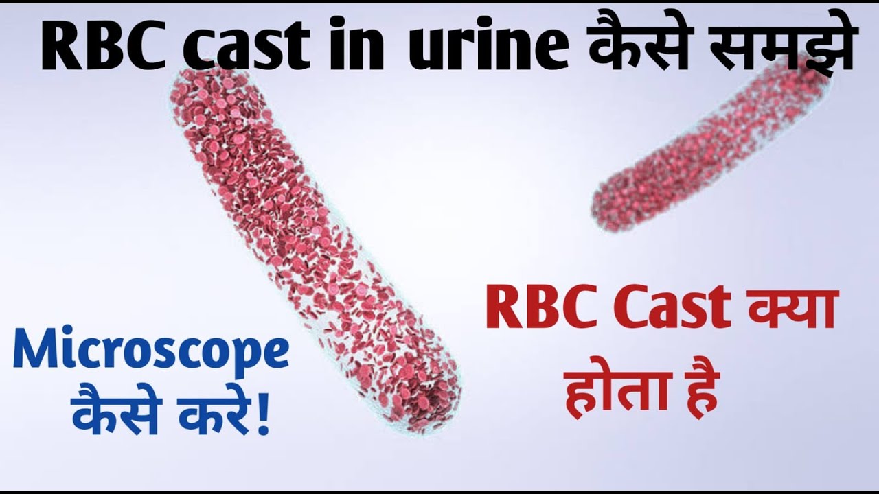 rcb cast in urine I crystals in urine under microscope - YouTube