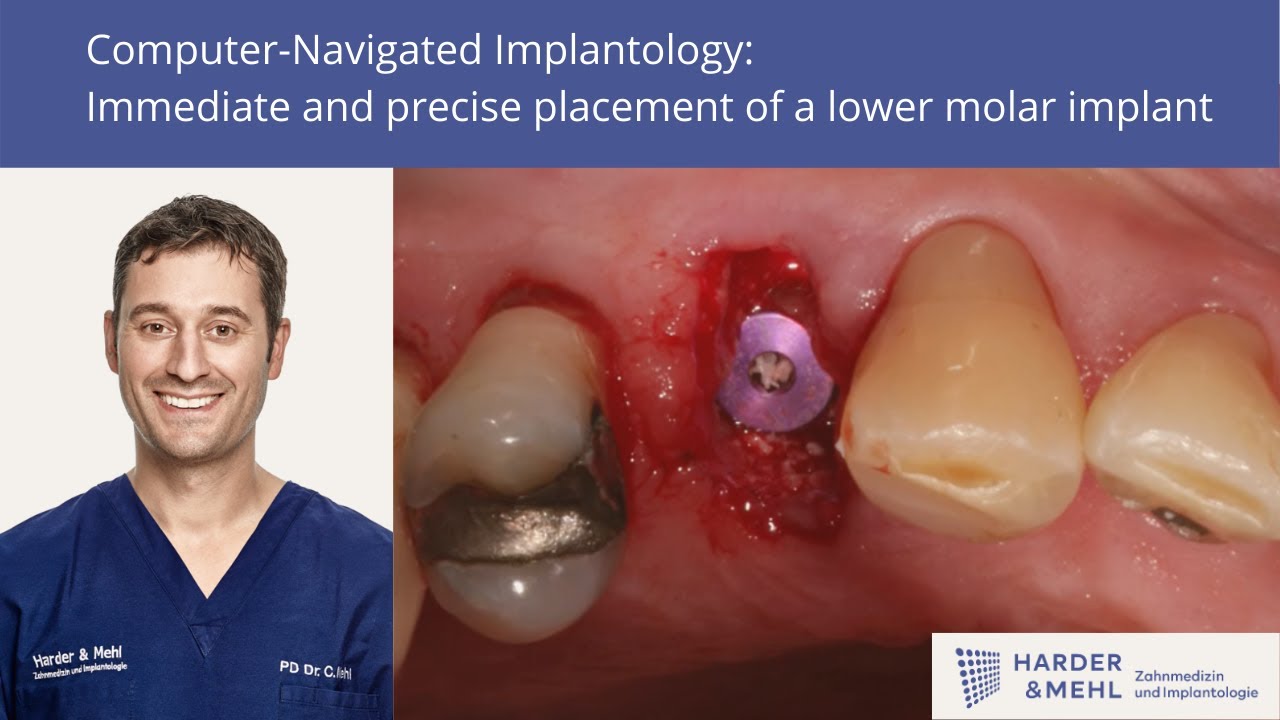 Computer-Navigated Implantology: Immediate placement of a lower molar ...