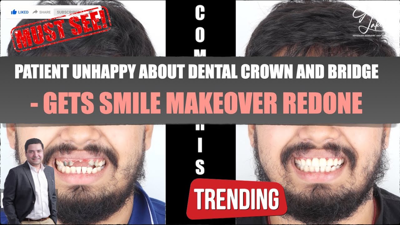 Poor Smile Designing Redone | Dental Capping Treatment | Dental Cap ...