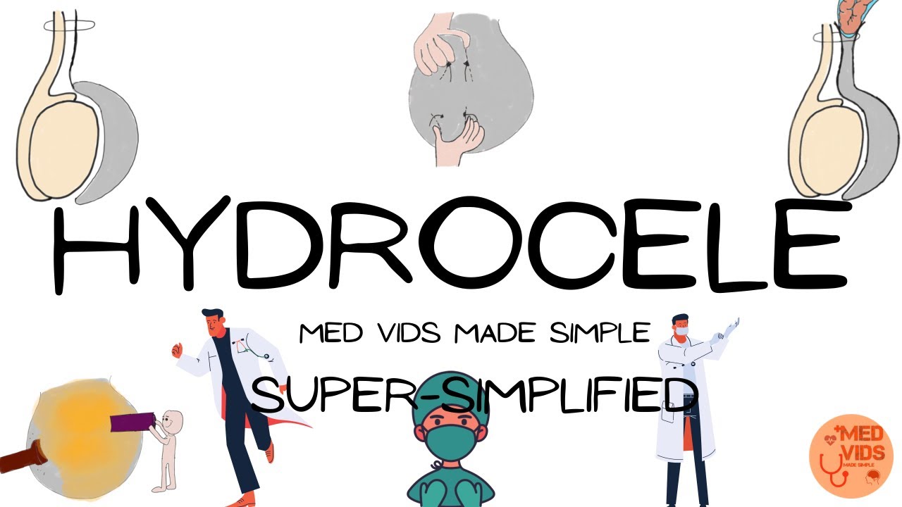 Hydrocele (Embryology, types, clinical features, examination, surgeries ...