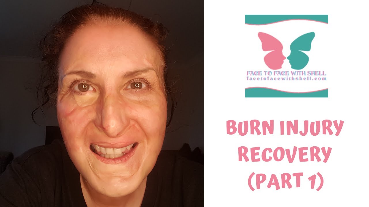 BURN INJURY RECOVERY (PART 1) - YouTube