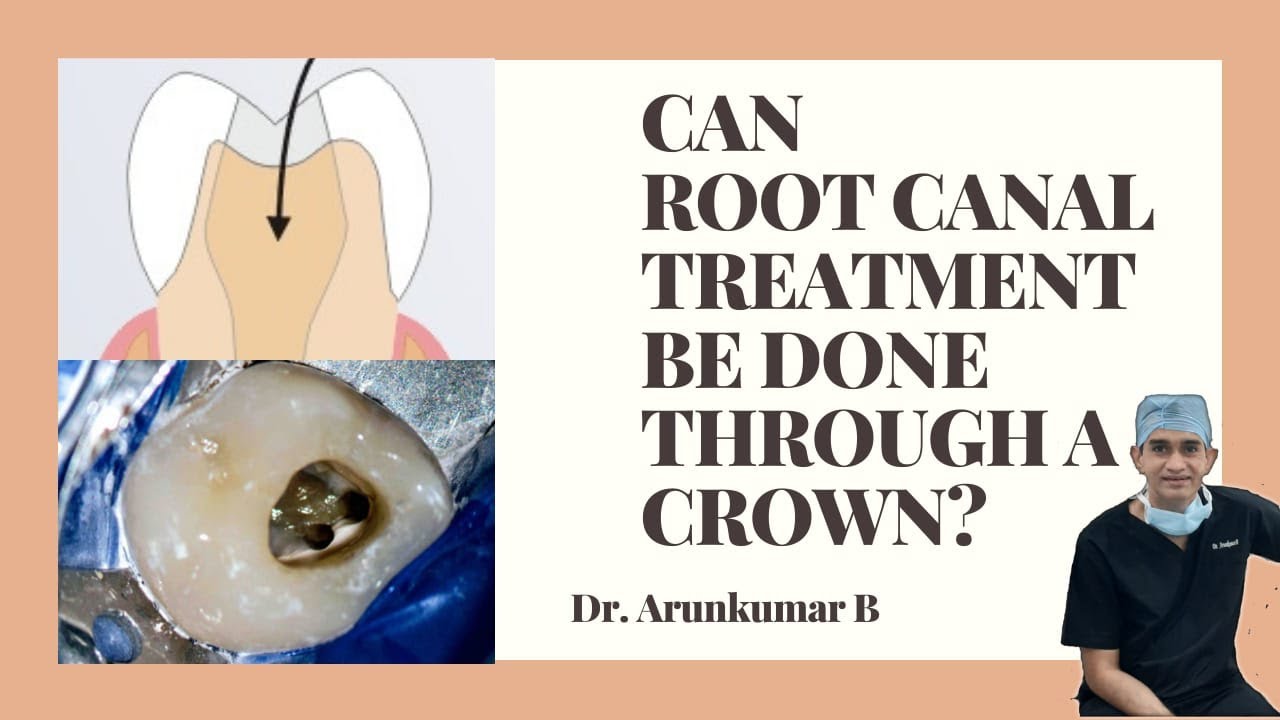 Can Root Canal Treatment done through Crowned Tooth? Dr Arunkumar ...