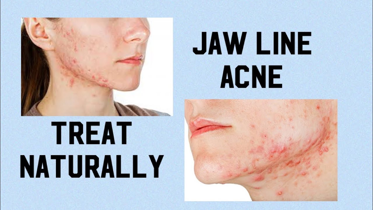 Hormonal Acne Jawline Acne Natural Treatment Of Acne Youtube