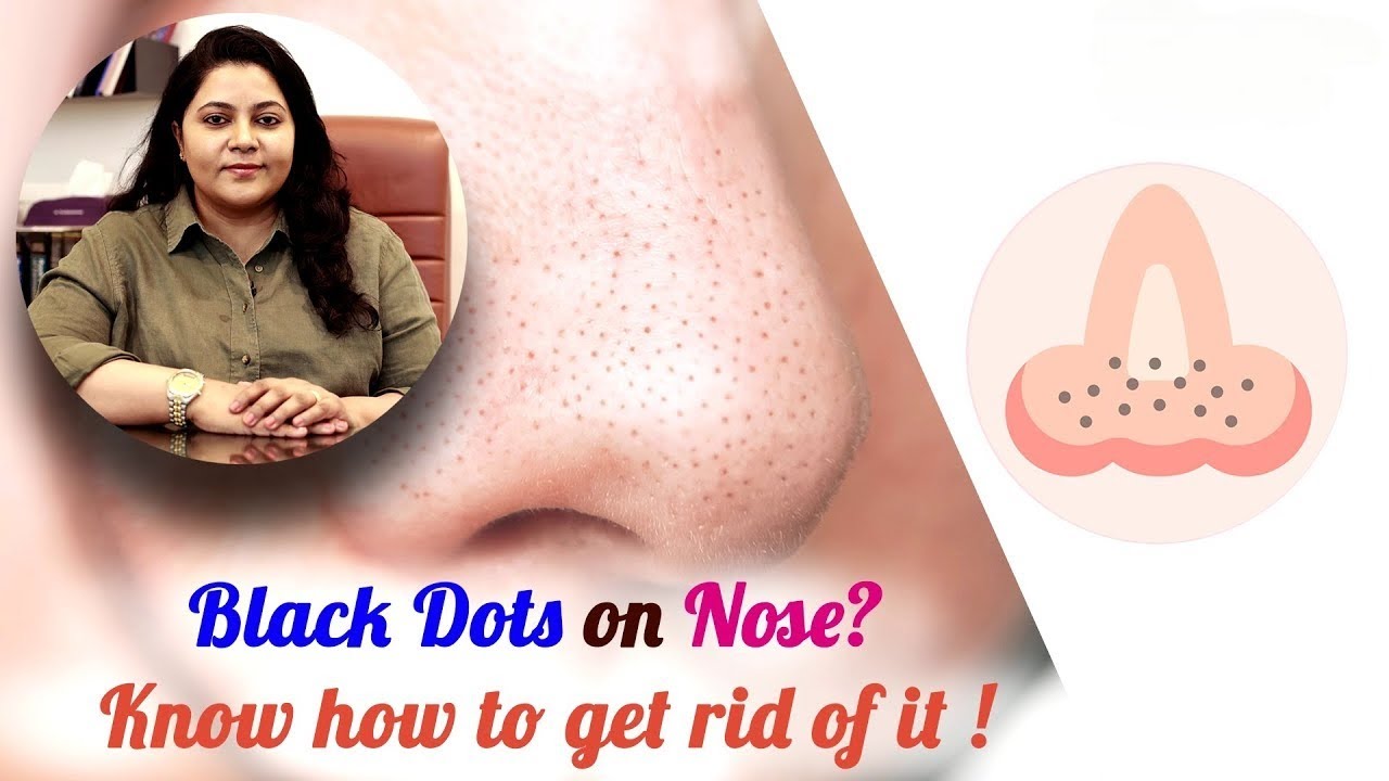 Black Heads Removal Tips From Top Dermatologist In Bangalore Dr Tina black-heads-removal-tips-from-top-dermatologist-in-bangalore-dr-tina