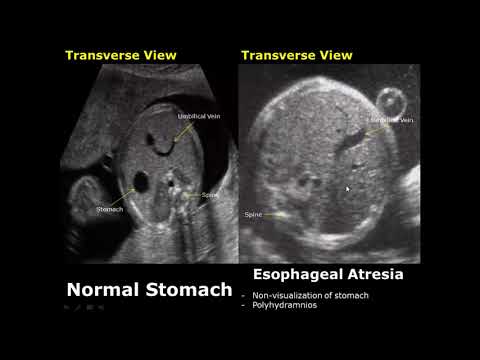 Fetal Stomach Ultrasound Normal Vs Abnormal Image Appearances | Fetal ...
