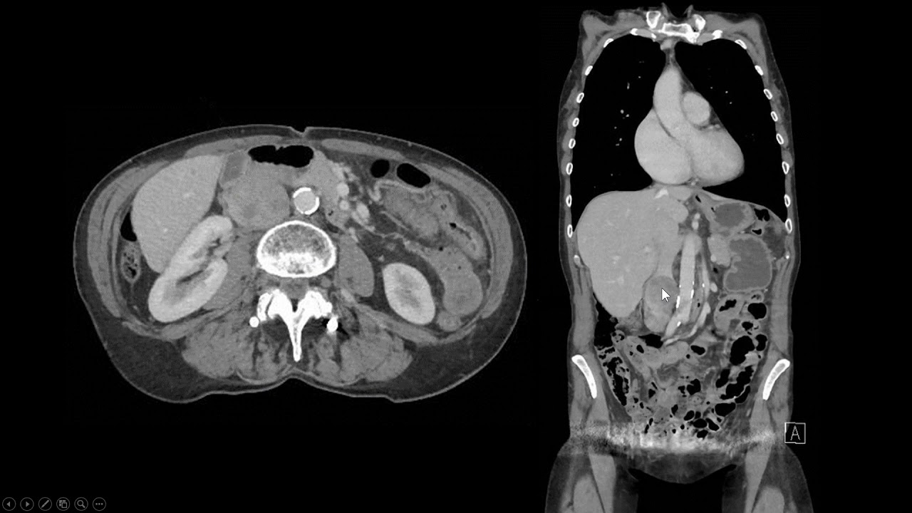 Leiomiossarcoma - YouTube