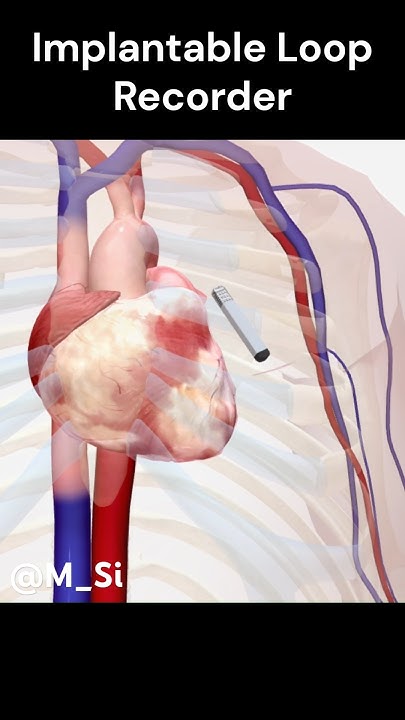 Implantable Loop Recorder - YouTube