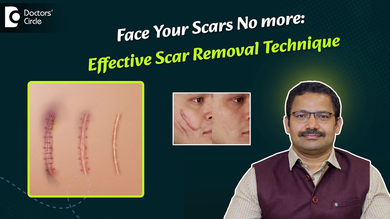 Accidental Scar Treatment on Face | Surgical Scar | - Dr Deepak P ...