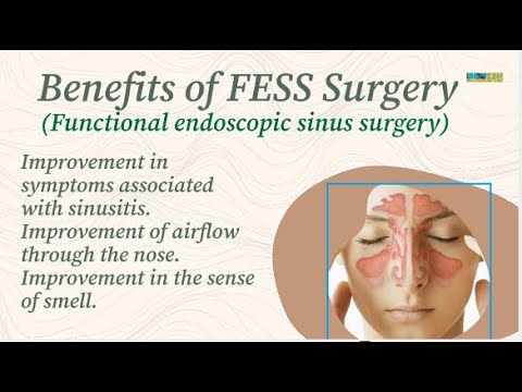 Benefits of FESS Surgery - YouTube