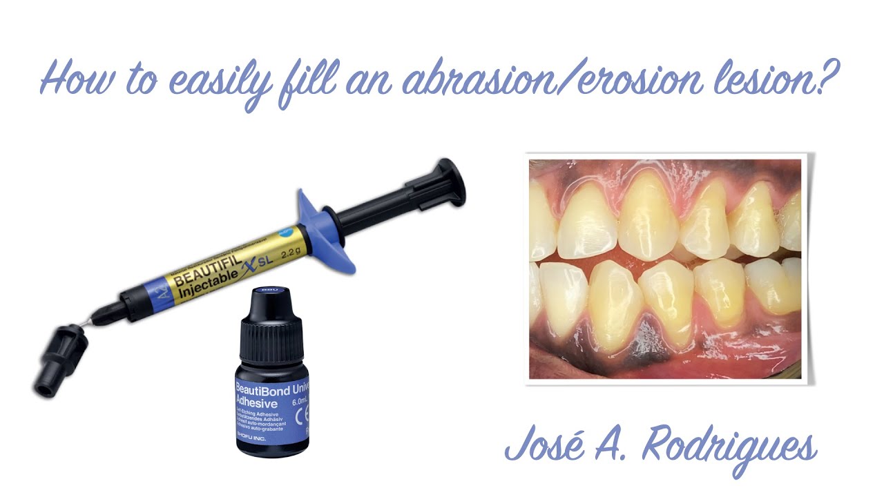 How to easily fill abrasion erosion lesion - YouTube