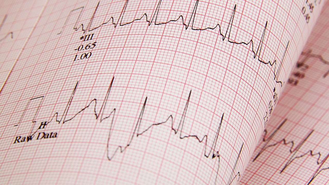 Human Physiology - Cardiac Output and Factors Affecting Cardiac Output ...
